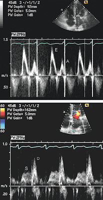 Lv Diastolic Dysfunction Grade 2 | Ahoy Comics