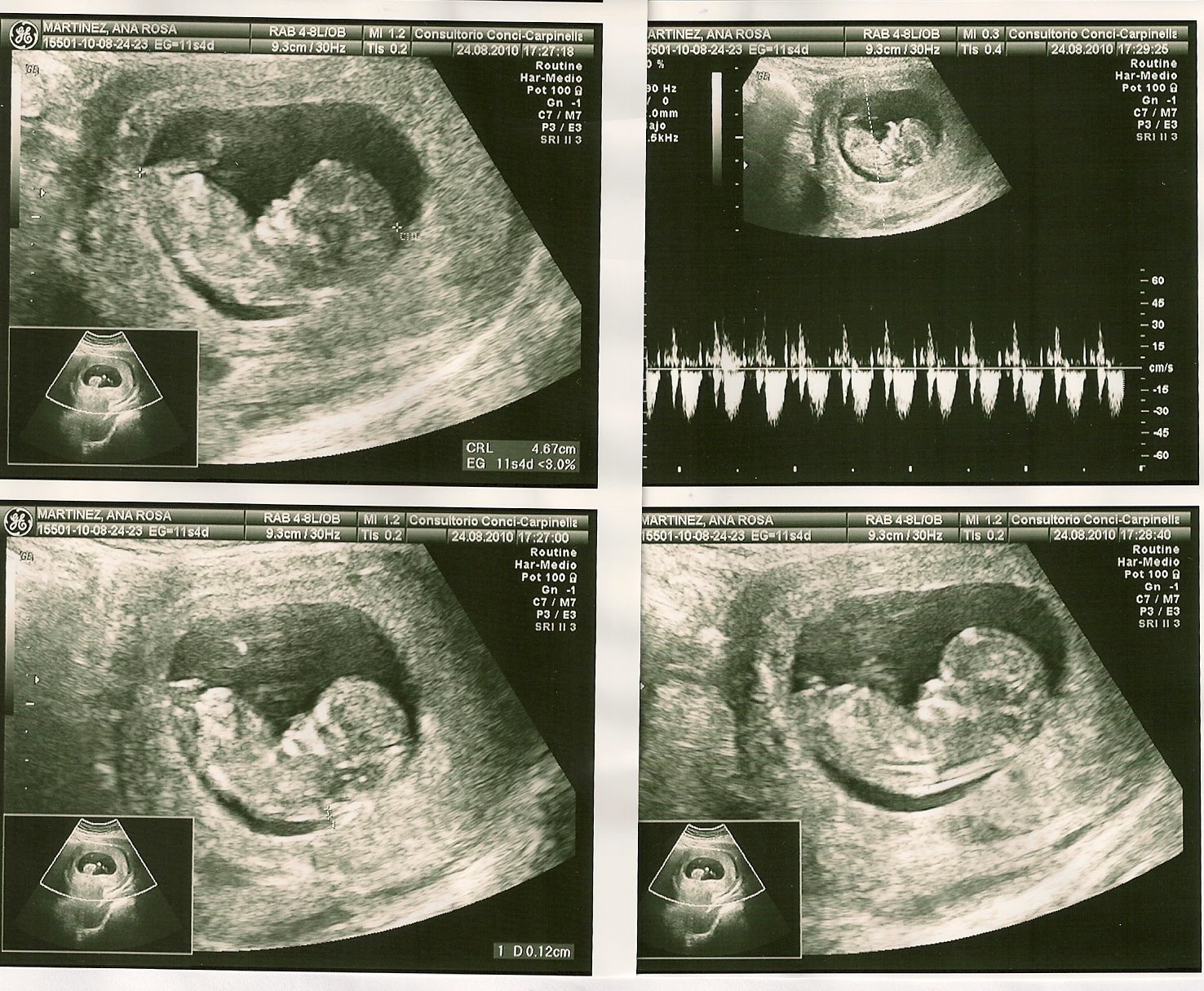 Ecografias de bebés de 11 semanas - Imagui