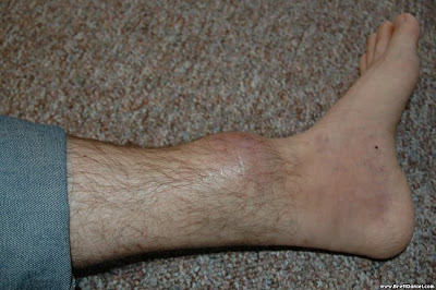 Informational Blog On Cancer & Health Care: The Lump caused by the Bone ...