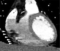 physics: ARTIFACTS IN SPIRAL CT