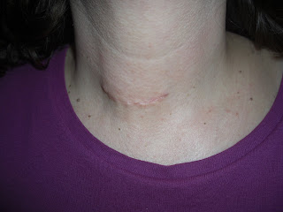 My Parathyroidectomy
