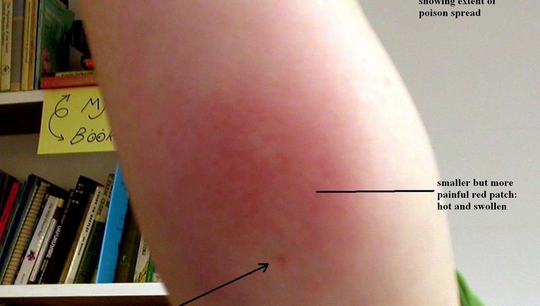 THE RANT FANTASTIC: Wasp sting