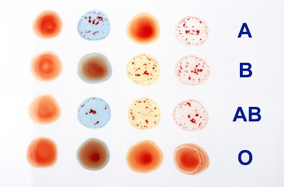 Blood Typing Clumping