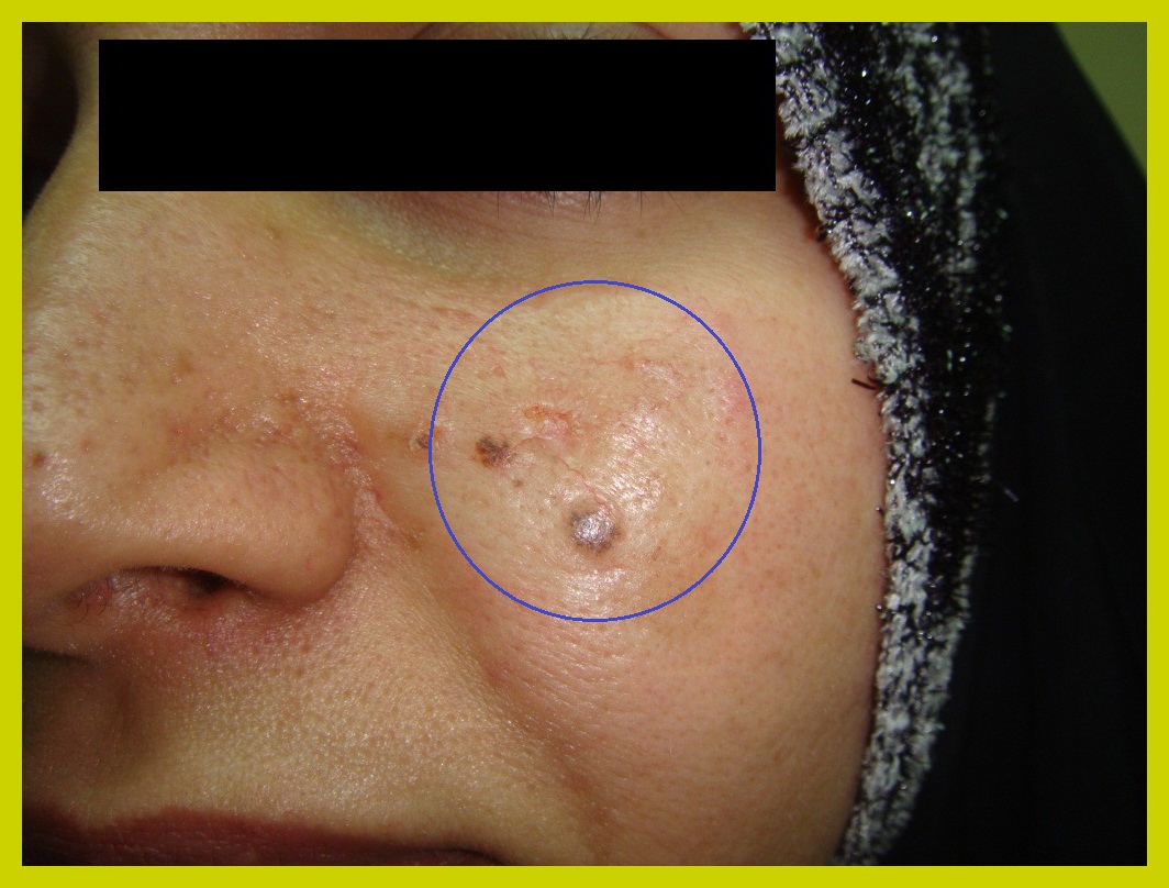 Skin Tumors: Morpheic BCC