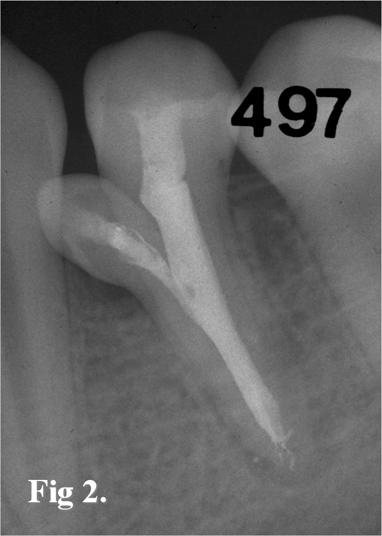BLOG DE LA CATEDRA DE ENDODONCIA USAL/AOA: Tratamiento Endodóntico de ...