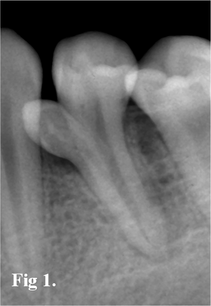 BLOG DE LA CATEDRA DE ENDODONCIA USAL/AOA: Tratamiento Endodóntico de ...