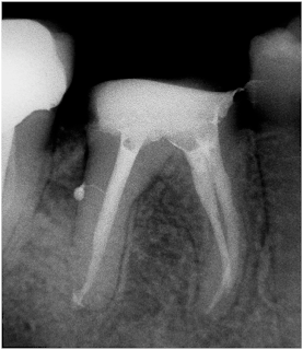 BLOG DE LA CATEDRA DE ENDODONCIA USAL/AOA: La obturación del conducto ...