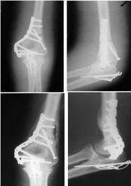 Logan :): Broken Bones