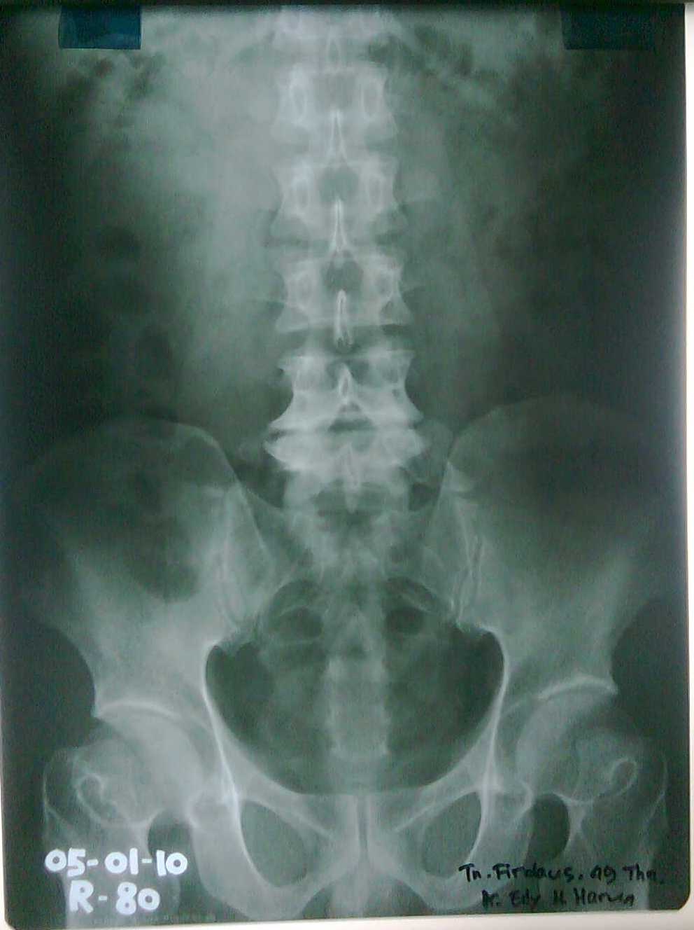 Cafe Radiologi: Teknik Radiografi BNO-IVP