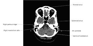 Hug Of Radiology: Anatomi dari gambaran CT Scan Kepala