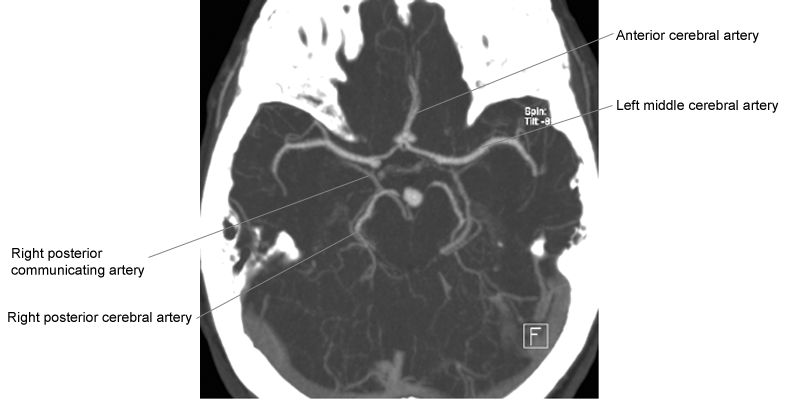Cafe Radiologi: Anatomi dari gambaran CT Scan Kepala