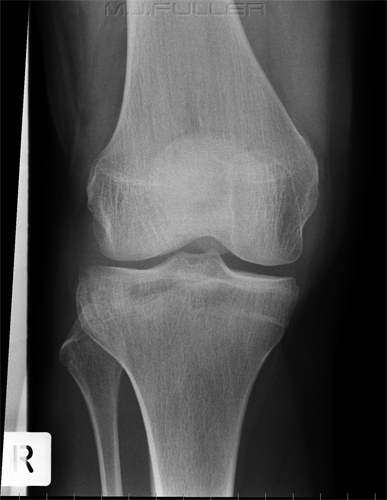 Khusnun Indah: TEKNIK PEMERIKSAAN GENU (KNEE JOINT)