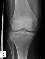 Khusnun Indah: TEKNIK PEMERIKSAAN GENU (KNEE JOINT)