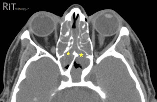 RiT radiology: Sinonasal Polyposis