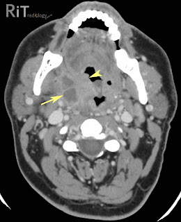 RiT radiology: Peritonsillar Abscess