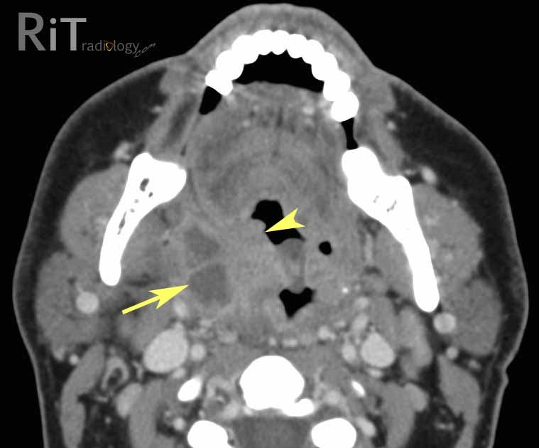 RiT radiology: Peritonsillar Abscess