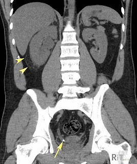 RiT radiology: Helical CT for Urolithiasis