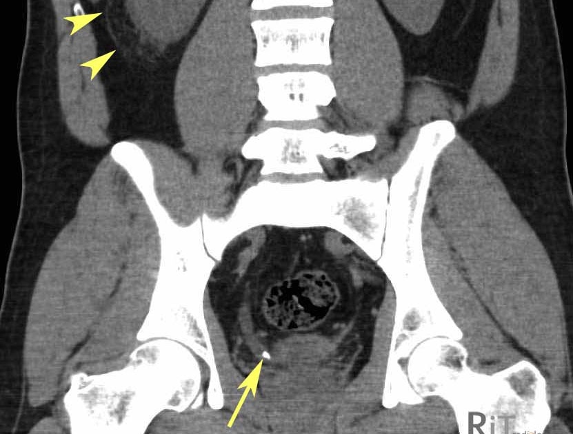 RiT radiology: Helical CT for Urolithiasis