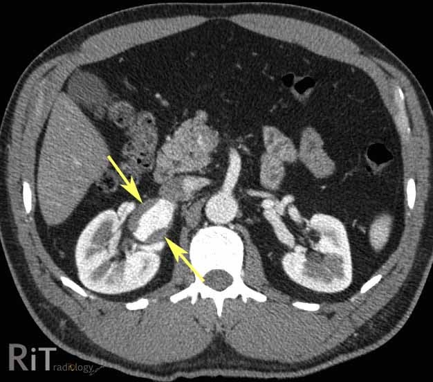 RiT radiology: Renal Artery Aneurysm