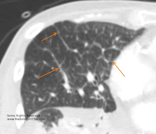 RiT radiology: Interlobular Septal Lines (Kerley's Lines)