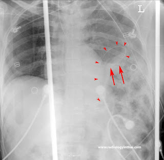 RiT radiology: Blunt Diaphragmatic Rupture