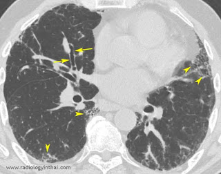 RiT radiology: Usual Interstitial Pneumonitis (UIP) Pattern