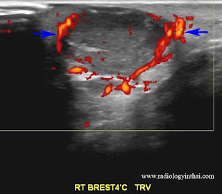 RiT radiology: Breast Mass in a Pregnant Woman