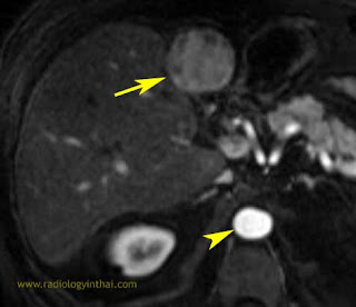 RiT radiology: Hypervascular Hepatic Mass