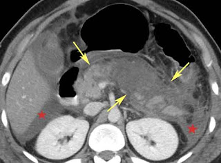 RiT radiology: Colon Cutoff Sign