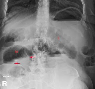 RiT radiology: Air-Fluid Levels at Different Heights in the Same Loop ...