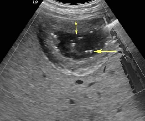 RiT radiology: Emphysematous Cholecystitis