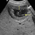 RiT radiology: Rim-rent Tear of Supraspinatous Tendon