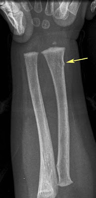 RiT radiology: Torus (Buckle) Fracture