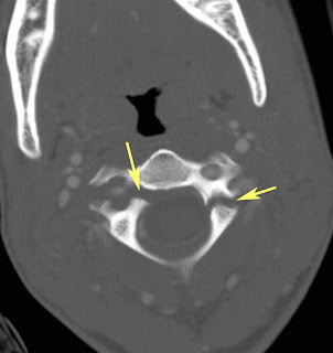 RiT radiology: Hangman's Fracture