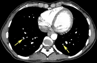 RiT radiology: Suspected Pulmonary Embolism in Pregnant Patient (3)