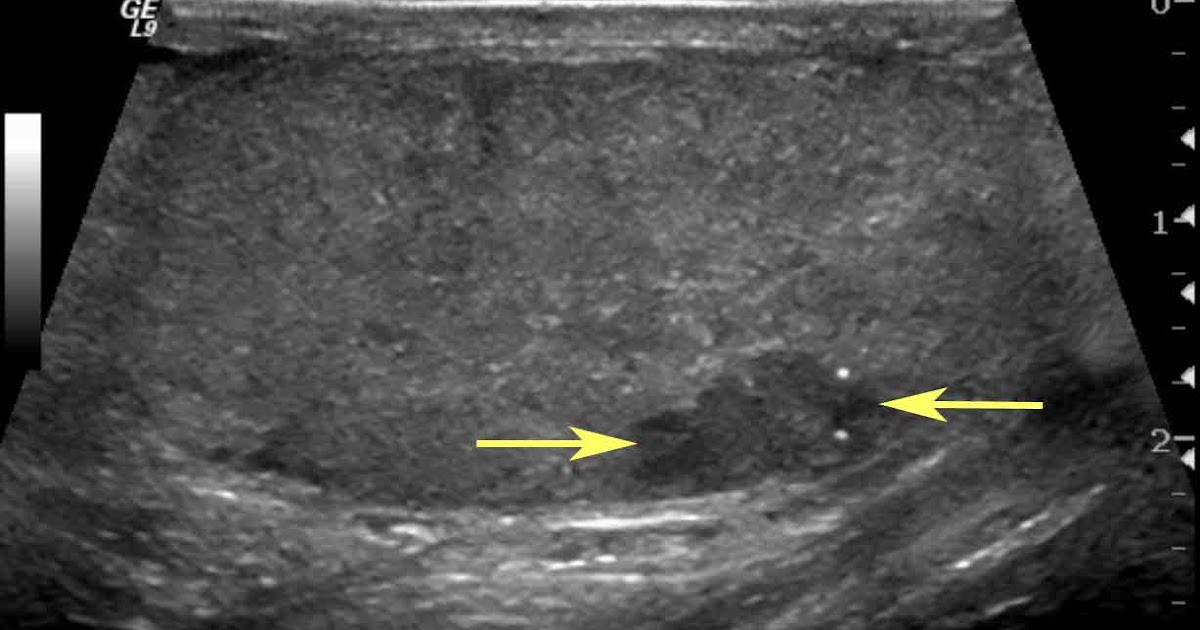 Rit Radiology Testicular Germ Cell Tumor