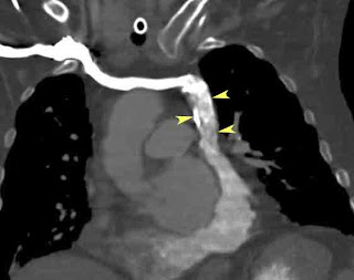 RiT radiology: Persistent Left Superior Vena Cava (SVC)