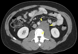 RiT radiology: Paraaortic Nodal Metastasis from Testicular Cancer