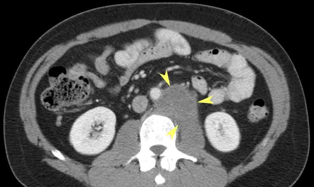 Rit Radiology Paraaortic Nodal Metastasis From Testicular Cancer