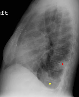 RiT radiology: Rounded Atelectasis
