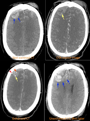 RiT radiology: CT Angiography "Spot Sign"