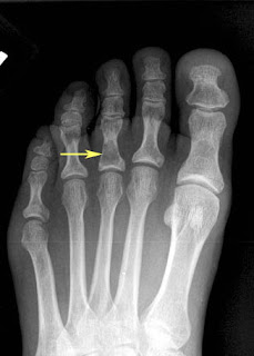 RiT radiology: Enchondroma of the Foot