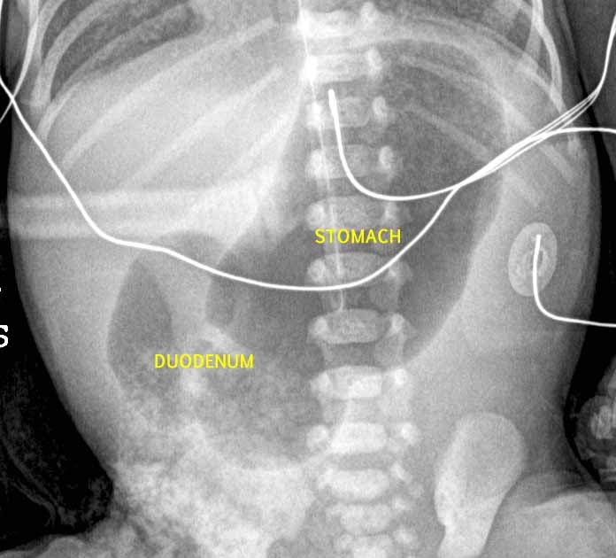 RiT radiology: Double Bubble Sign