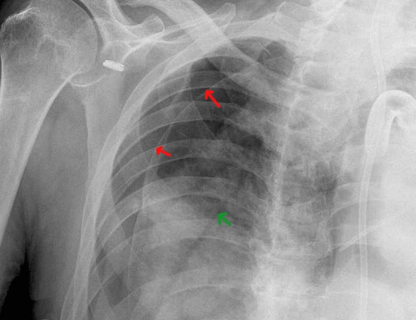RiT radiology: Pneumothorax Versus Skin Fold