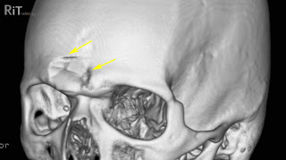 RiT radiology: Frontal Sinus Fracture