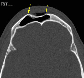RiT radiology: Frontal Sinus Fracture