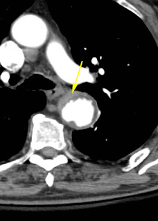 RiT radiology: Aortic Intramural Hematoma (IMH)