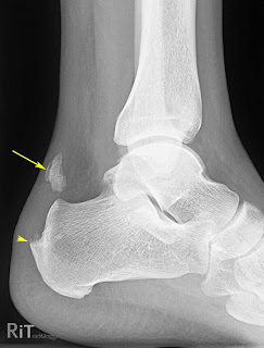 RiT radiology: Achilles Tendon Rupture