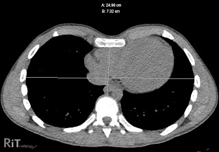 RiT radiology: Pectus Excavatum