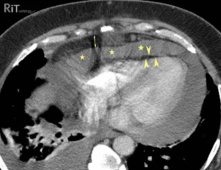 RiT radiology: Pericardial Effusion - Oreo Cookie Sign